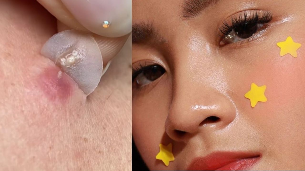 Parches para acné: beneficios reales, mitos y cómo usarlos ...